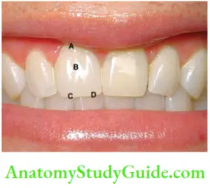 Discoloration Of Teeth Causes Treatment And Management Notes - Anatomy ...