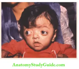 Dysmorphic Features In Pediatrics Notes - Anatomy Study Guide