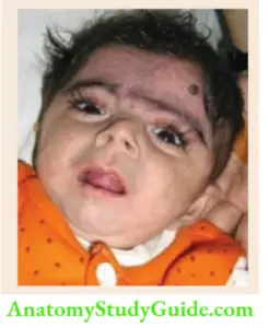 Dysmorphic Features In Pediatrics Notes - Anatomy Study Guide