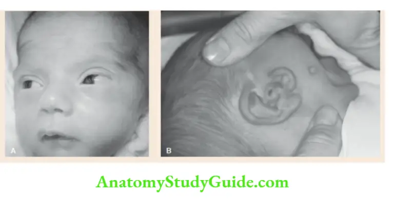 Dysmorphic Features In Pediatrics Notes - Anatomy Study Guide