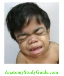 Dysmorphic Features In Pediatrics Notes - Anatomy Study Guide