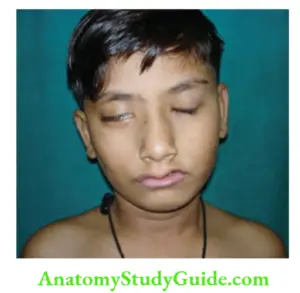 Dysmorphic Features In Pediatrics Notes - Anatomy Study Guide