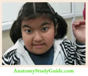 Dysmorphic Features In Pediatrics Notes - Anatomy Study Guide