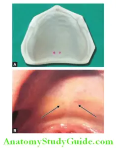 Anatomical Landmarks Edentulous Maxillary Arch Notes - Anatomy Study Guide