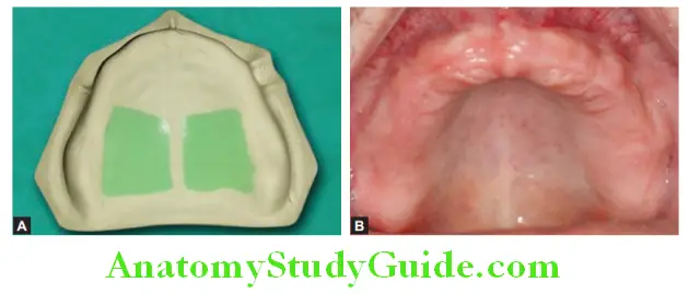 Anatomical Landmarks Edentulous Maxillary Arch Notes - Anatomy Study Guide