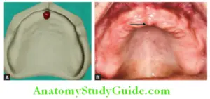 Anatomical Landmarks Edentulous Maxillary Arch Notes - Anatomy Study Guide