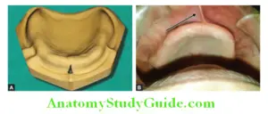 Anatomical Landmarks Edentulous Maxillary Arch Notes - Anatomy Study Guide