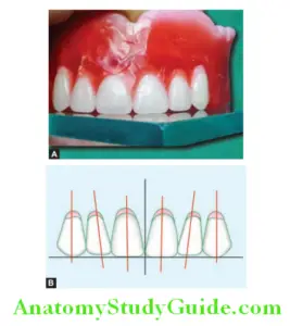 Complete Denture – Selection & Arrangement of Artificial Teeth ...