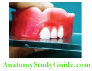 Complete Denture – Selection & Arrangement of Artificial Teeth ...