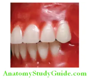 Complete Denture – Selection & Arrangement of Artificial Teeth ...