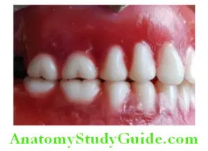Complete Denture – Selection & Arrangement of Artificial Teeth ...