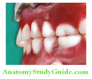 Complete Denture – Selection & Arrangement of Artificial Teeth ...