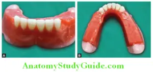 Complete Denture – Selection & Arrangement of Artificial Teeth ...