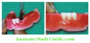 Complete Denture – Selection & Arrangement of Artificial Teeth ...
