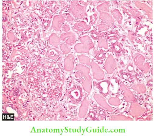 Cell Death Pathways In Irreversible Injury - Anatomy Study Guide