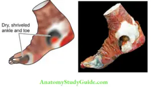 Types Of Gangrene And Their Symptoms - Anatomy Study Guide