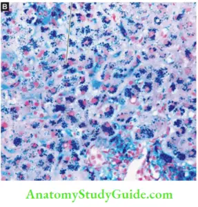 Pigments Endogenous And Exogenous Pathology Notes - Anatomy Study Guide
