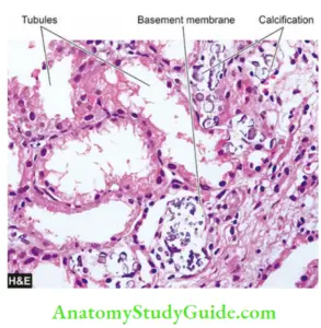 Pathologic Calcification Notes - Anatomy Study Guide
