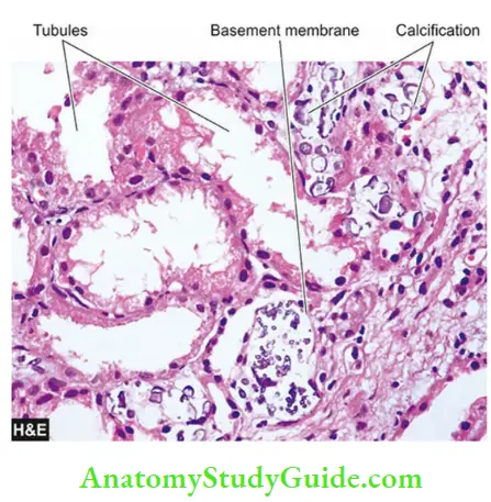 Pathologic Calcification Notes - Anatomy Study Guide