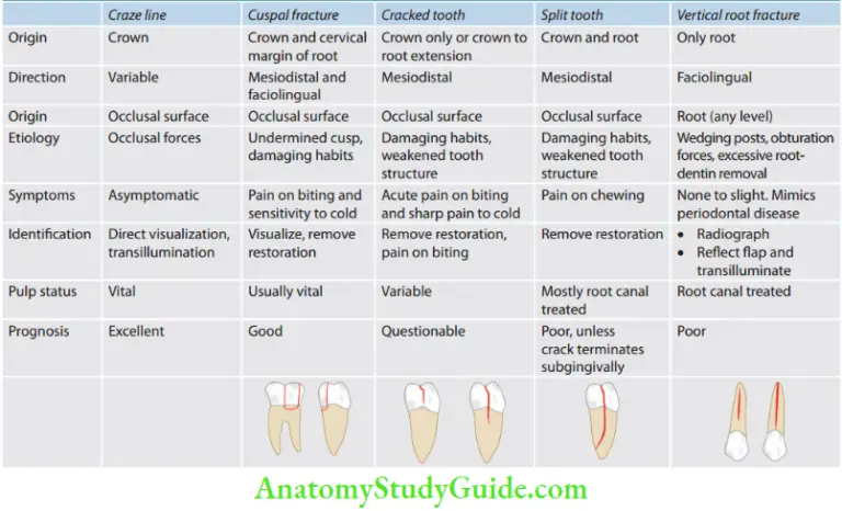 Vertical Root Fracture And Crack Tooth Syndrome Notes - Anatomy Study Guide