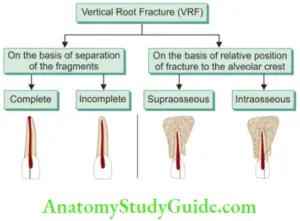 Vertical Root Fracture And Crack Tooth Syndrome Notes - Anatomy Study Guide