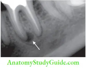 Vertical Root Fracture And Crack Tooth Syndrome Notes - Anatomy Study Guide