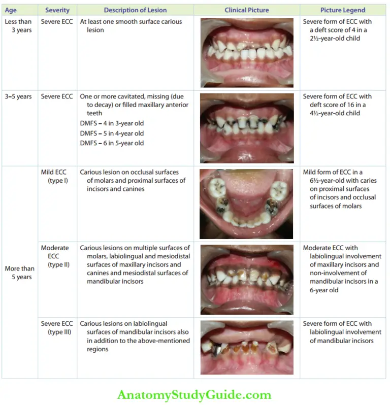 Early Childhood Caries Notes - Anatomy Study Guide