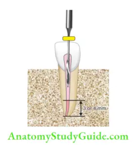 Endodontic Instruments Classification Notes - Anatomy Study Guide
