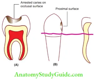 Essentials Of Dental Caries Notes - Anatomy Study Guide