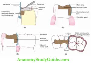 Isolation Matricing And Wedging Notes - Anatomy Study Guide