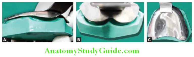 Making Primary Impression of Maxillary and Mandibular Edentulous ...