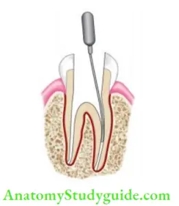Midtreatment Flare Ups In Endodontics Notes - Anatomy Study Guide