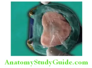 Complete Denture – Flasking, Dewaxing & Packing Notes - Anatomy Study Guide