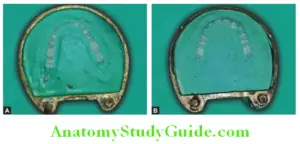 Complete Denture – Flasking, Dewaxing & Packing Notes - Anatomy Study Guide