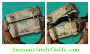 Complete Denture – Flasking, Dewaxing & Packing Notes - Anatomy Study Guide