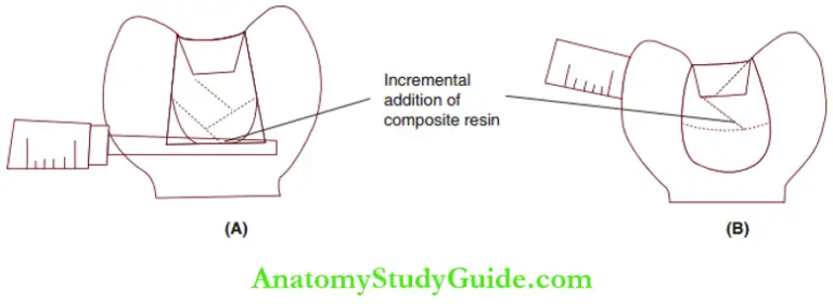 Resin Restorations On Primary Teeth Notes - Anatomy Study Guide