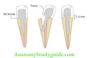 Restoration Of Endodontically Treated Teeth - Anatomy Study Guide