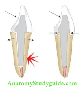 Restoration Of Endodontically Treated Teeth - Anatomy Study Guide