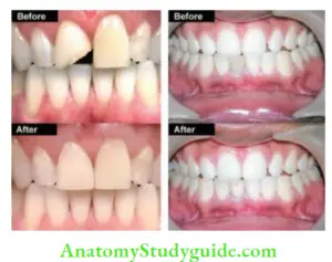 Restoration Of Endodontically Treated Teeth - Anatomy Study Guide