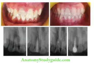 Restoration Of Endodontically Treated Teeth - Anatomy Study Guide