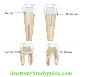 Restoration Of Endodontically Treated Teeth - Anatomy Study Guide