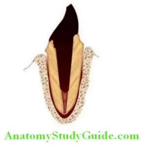 Restoration Of Endodontically Treated Tooth Notes - Anatomy Study Guide