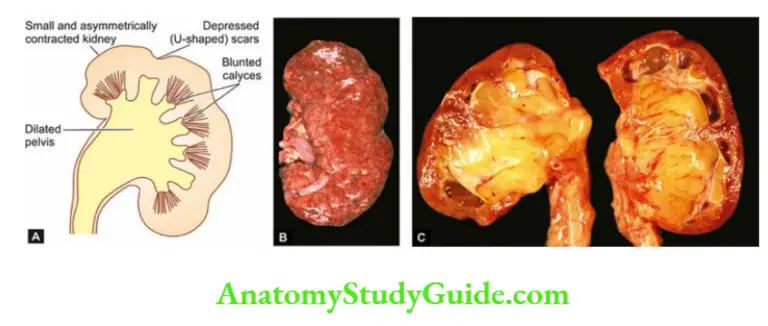 The Kidney And Lower Urinary Tract Pathology Notes - Anatomy Study Guide