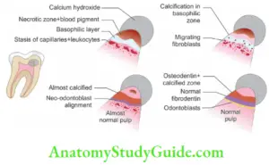 Direct and Indirect Pulp Capping Notes - Anatomy Study Guide