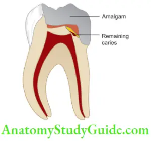 Direct and Indirect Pulp Capping Notes - Anatomy Study Guide