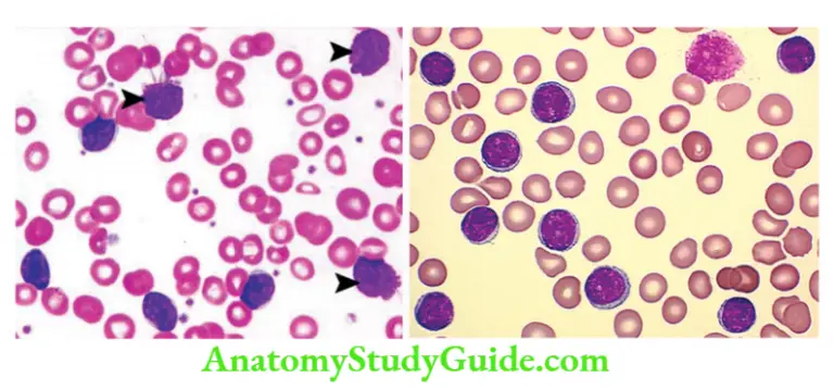 White Blood Cells Disorder And Lymph Nodes Question and answers ...