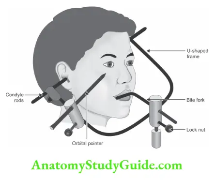 Use of Facebow Device in Prosthodontics - Anatomy Study Guide