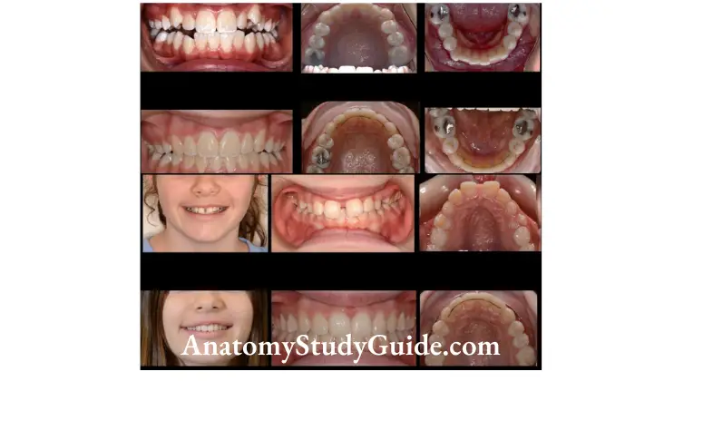 Condylar Guidance In Articulator and Bilateral Balanced Occlusion ...