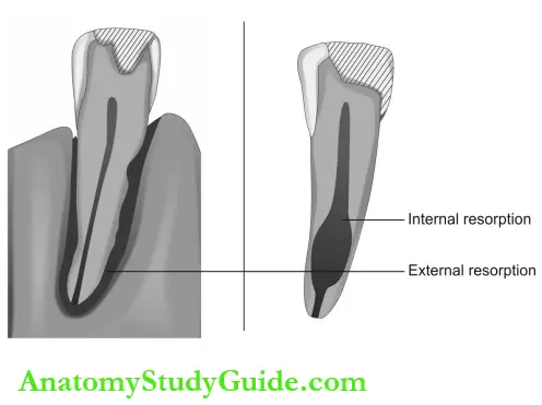 Periapical Pathological Feature Pulp and Periapical Diseases Notes ...