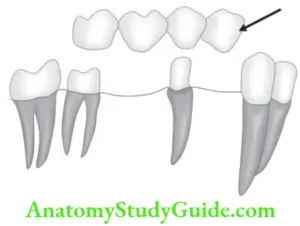 Cantilever Fixed Partial Denture - Anatomy Study Guide